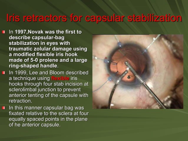 Update on pupil stretching and capsular stabilization devices | PPT