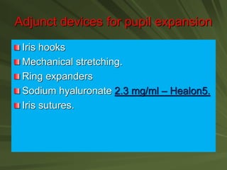 Update on pupil stretching and capsular stabilization devices | PPT