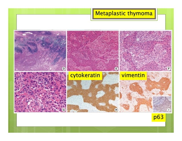 Update on thymomas | PPT