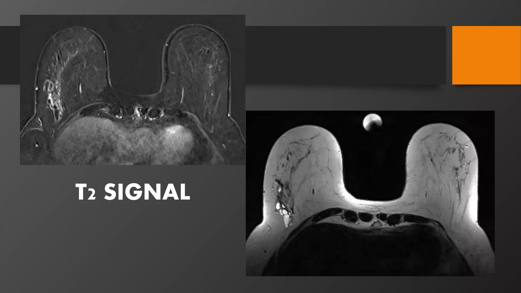 Updates and revision to the MRI BI-RADS Lexicon | PPTX