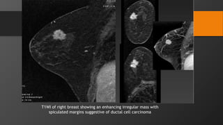 Updates and revision to the MRI BI-RADS Lexicon | PPTX
