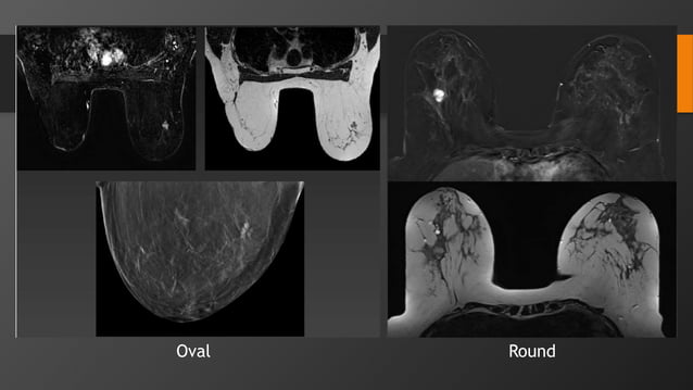 Updates and revision to the MRI BI-RADS Lexicon | PPT