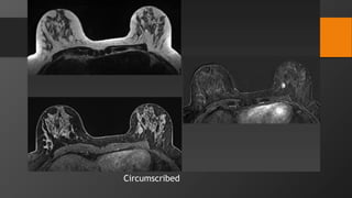 Updates and revision to the MRI BI-RADS Lexicon | PPTX