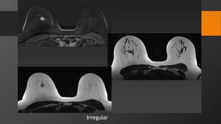 Updates and revision to the MRI BI-RADS Lexicon | PPTX