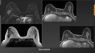 Updates and revision to the MRI BI-RADS Lexicon | PPTX