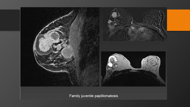 Updates and revision to the MRI BI-RADS Lexicon | PPT
