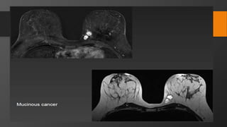 Updates and revision to the MRI BI-RADS Lexicon | PPTX