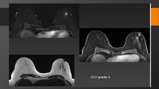 Updates and revision to the MRI BI-RADS Lexicon | PPTX