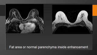 Updates and revision to the MRI BI-RADS Lexicon | PPTX