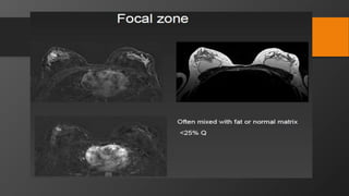 Updates and revision to the MRI BI-RADS Lexicon | PPTX