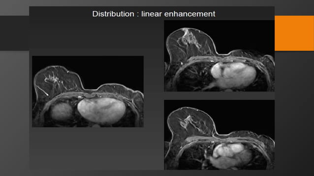 Updates and revision to the MRI BI-RADS Lexicon | PPT