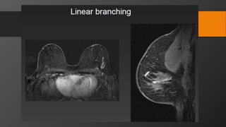 Updates and revision to the MRI BI-RADS Lexicon | PPTX