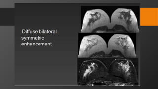 Updates and revision to the MRI BI-RADS Lexicon | PPTX