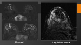 Updates and revision to the MRI BI-RADS Lexicon | PPTX