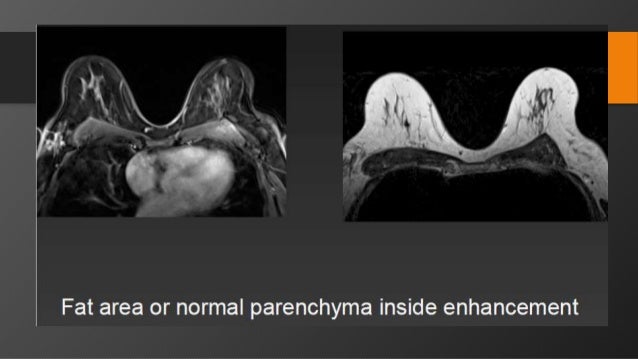 Updates and revision to the MRI BI-RADS Lexicon