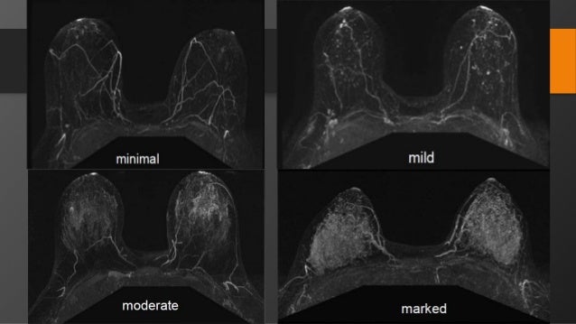 Updates and revision to the MRI BI-RADS Lexicon