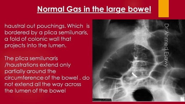 Update secrets in plain x ray abdomen gases ,air fluid level . | PPT