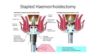 Updates in Coloproctology & colorectal surgery | PPTX