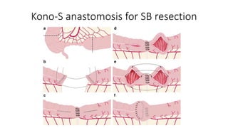 Updates in Coloproctology & colorectal surgery | PPTX