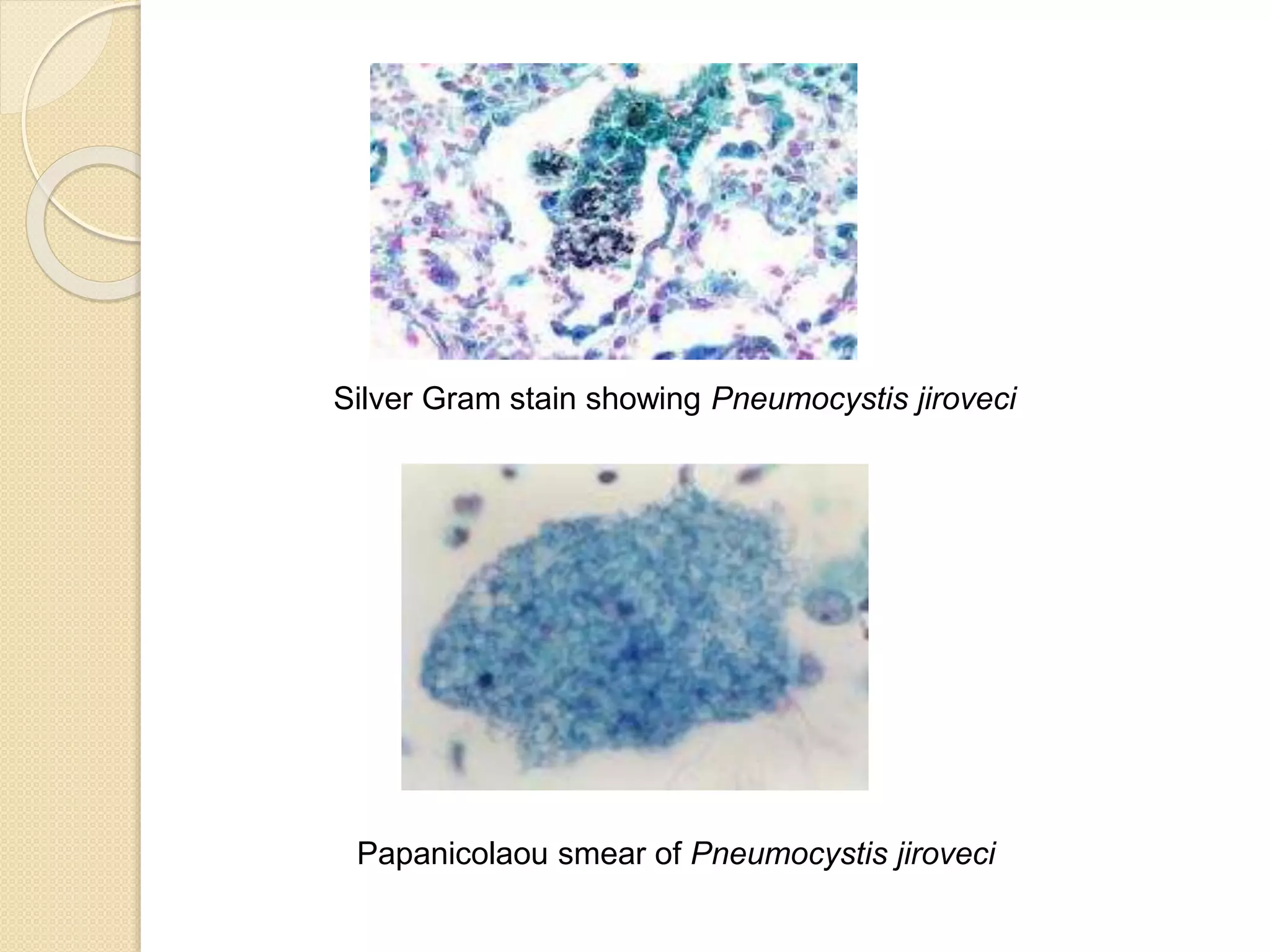 pneumocystis pneumonia | PPTX
