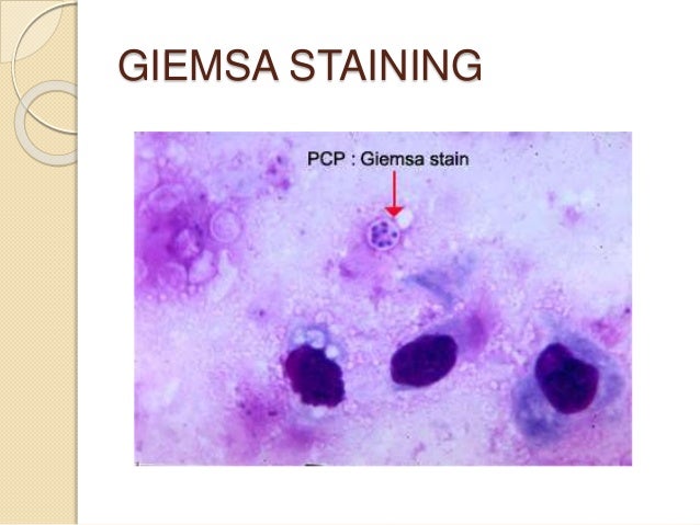 pneumocystis pneumonia
