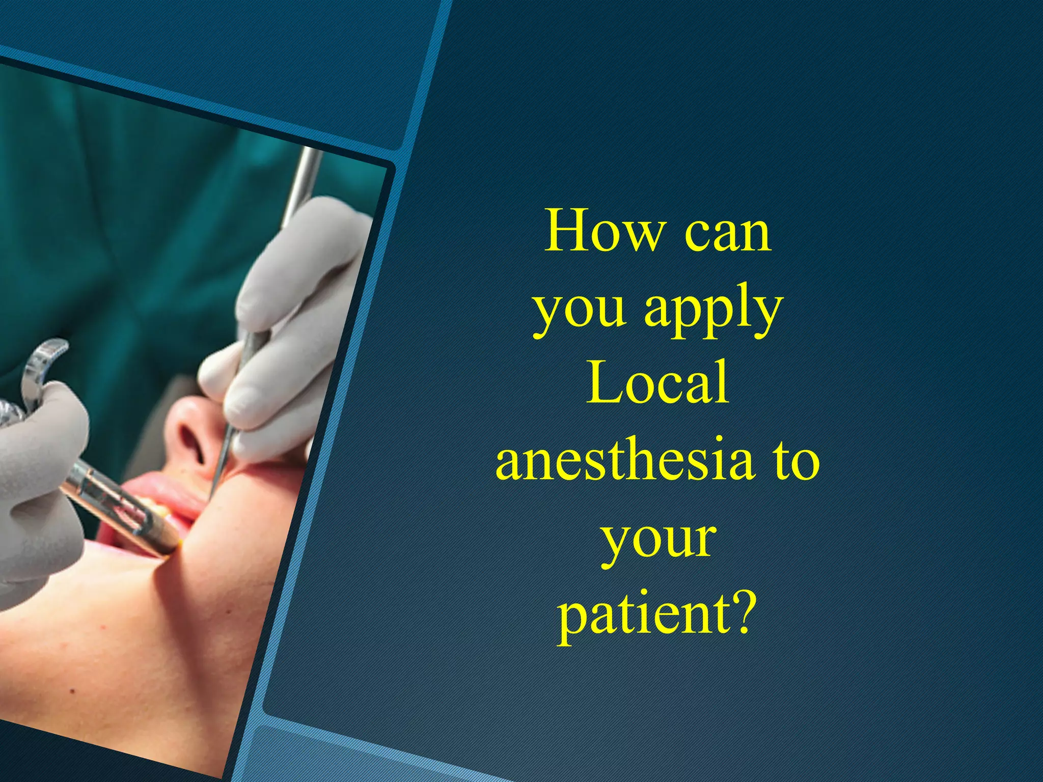 Updates in local anesthesia technique | PDF