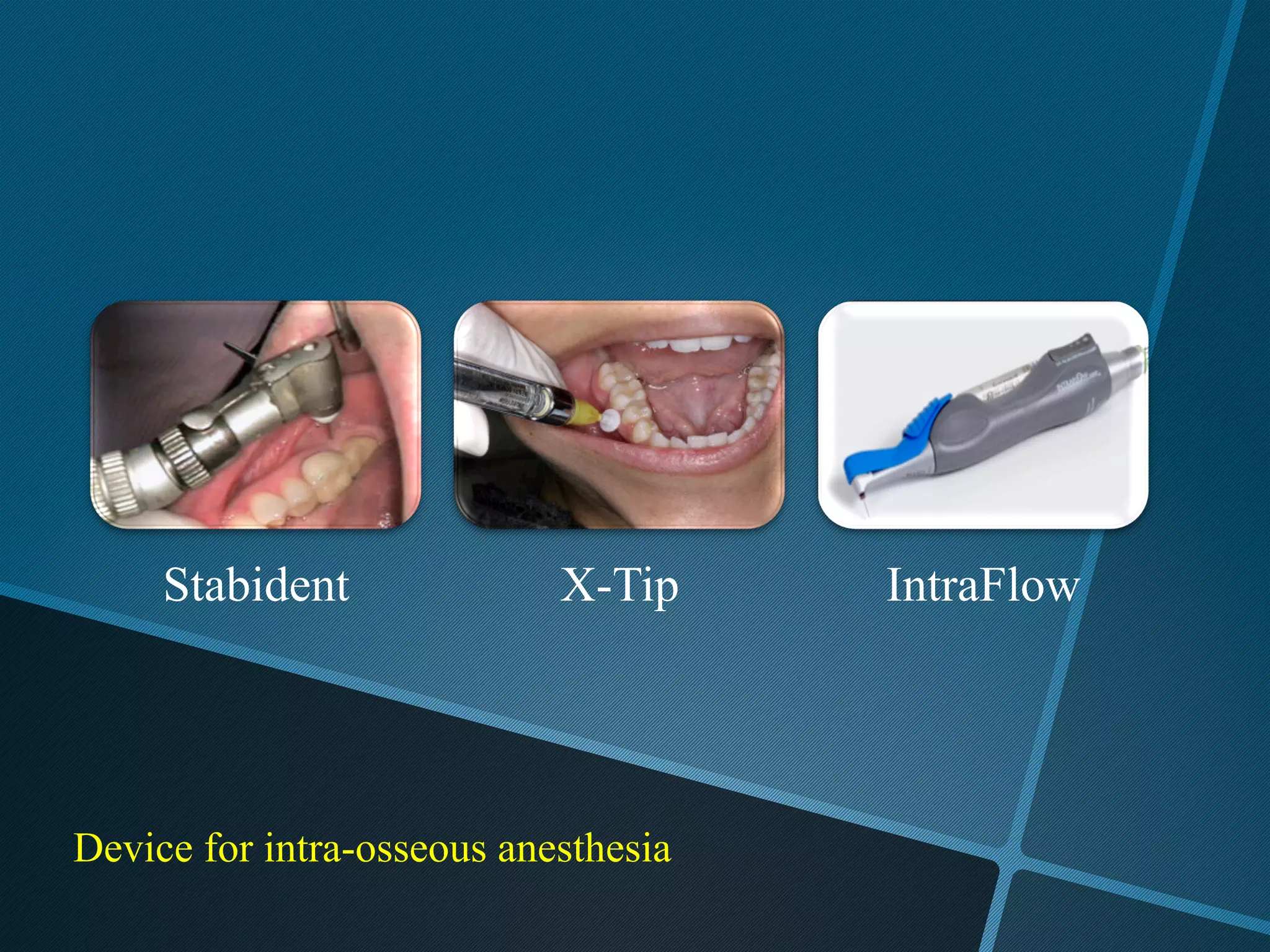 Updates in local anesthesia technique | PDF