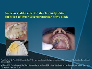 Updates in local anesthesia technique | PDF