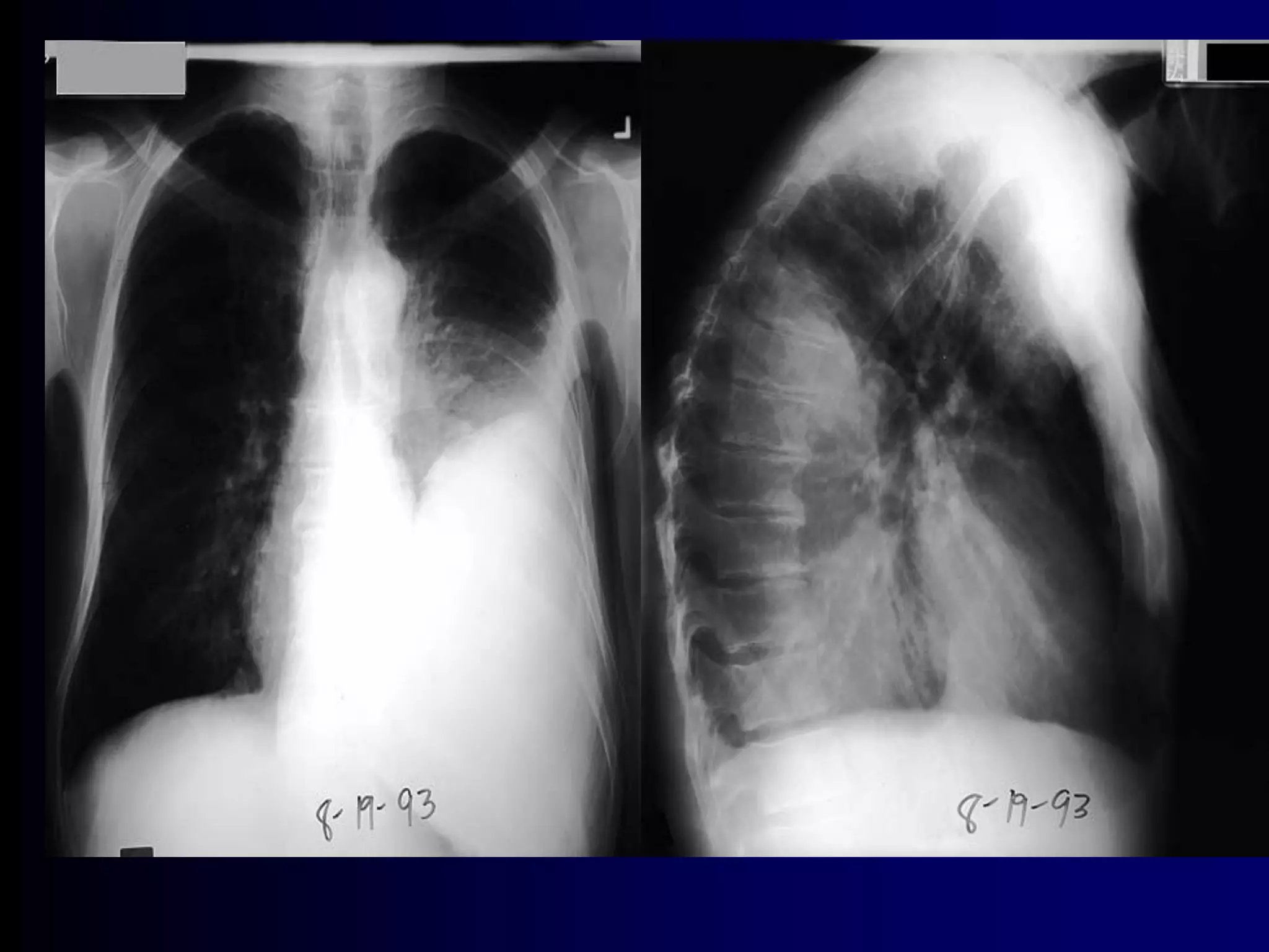 Updates in Parapneumonic Effusion and Empyema | PDF