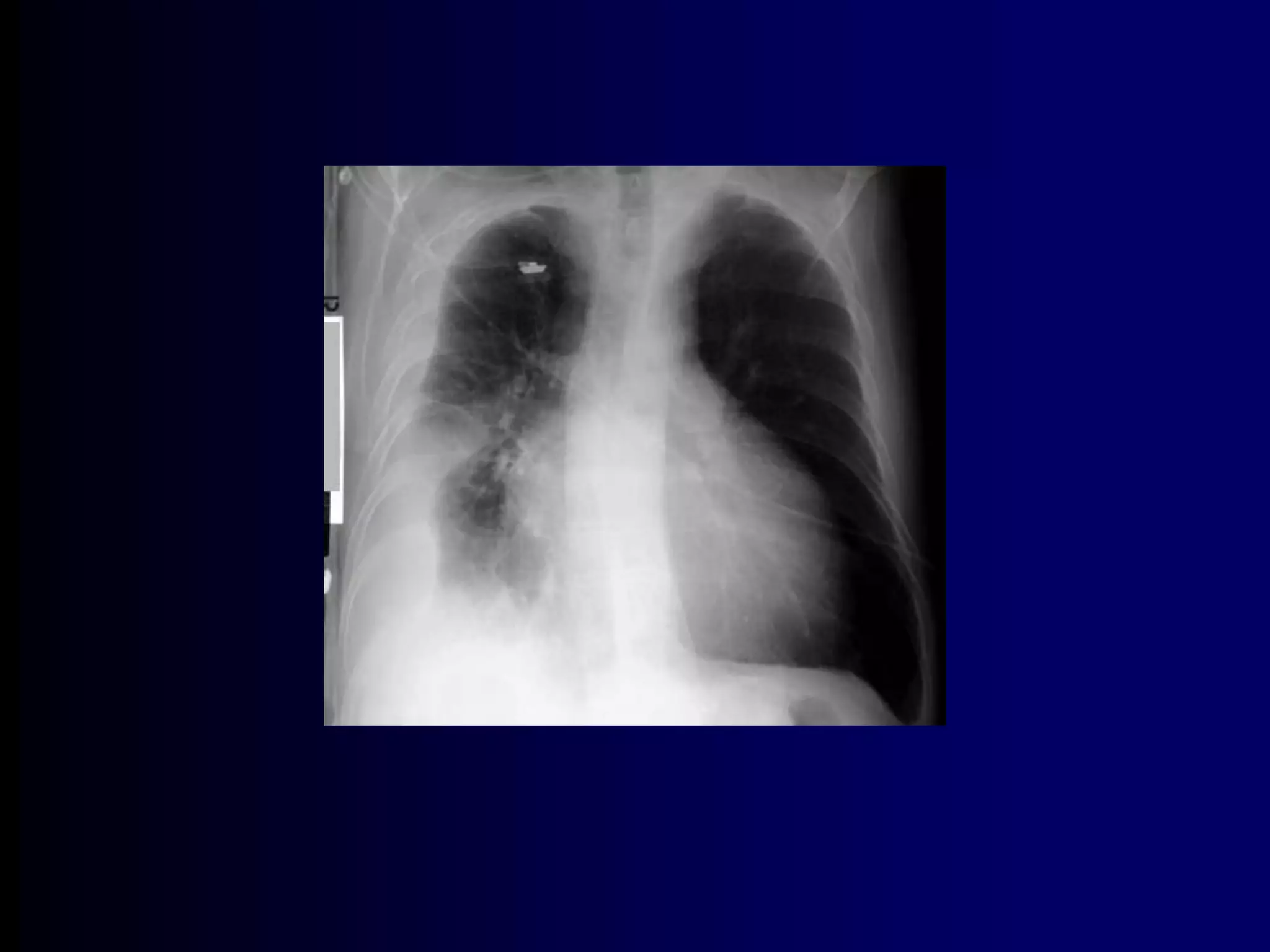 Updates in Parapneumonic Effusion and Empyema | PDF