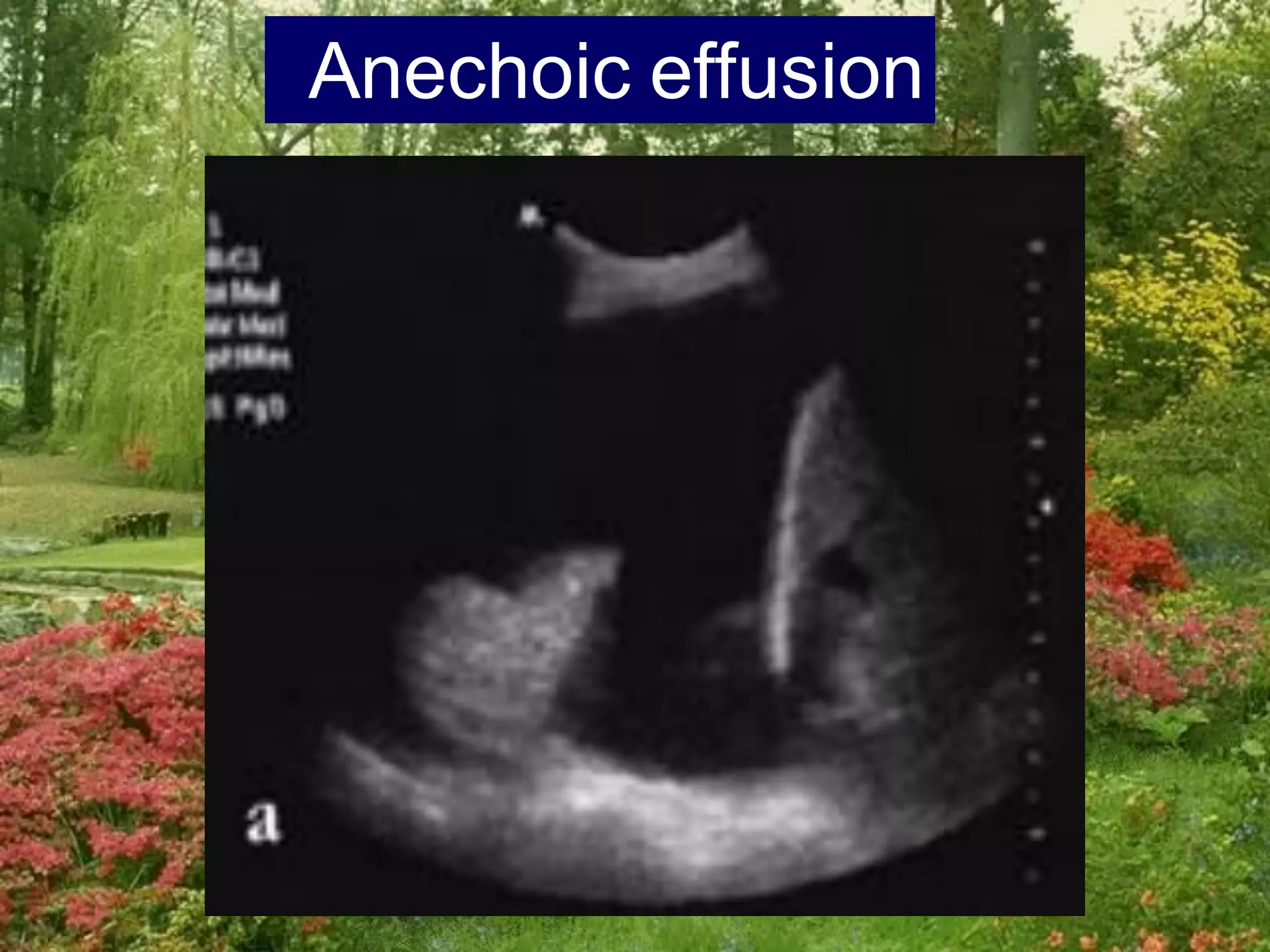 Updates in Parapneumonic Effusion and Empyema | PDF