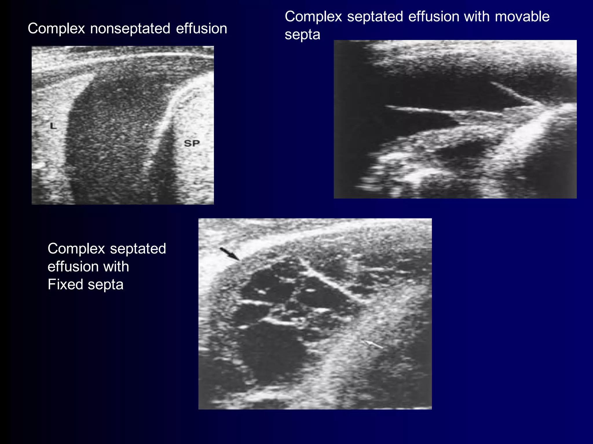Updates in Parapneumonic Effusion and Empyema | PDF