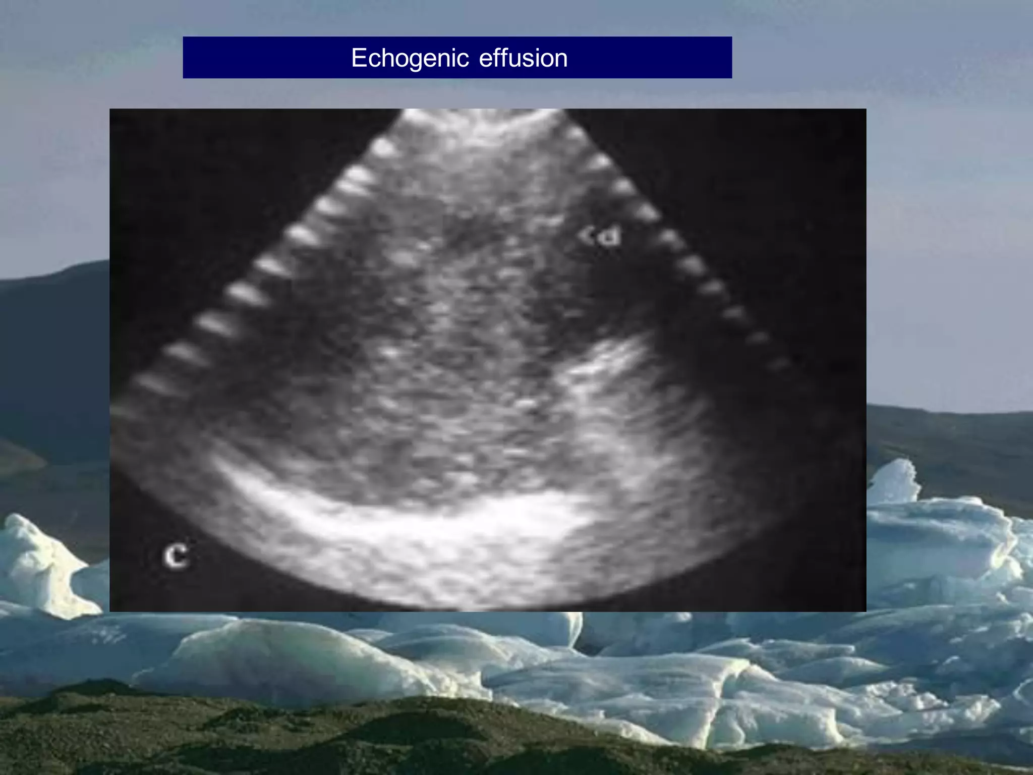 Updates in Parapneumonic Effusion and Empyema | PDF