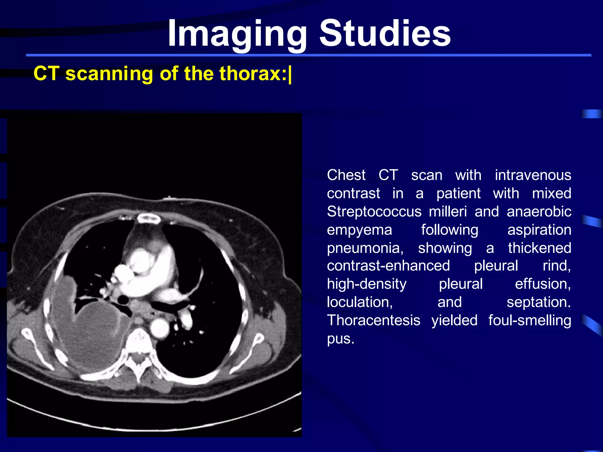 Updates in Parapneumonic Effusion and Empyema | PDF