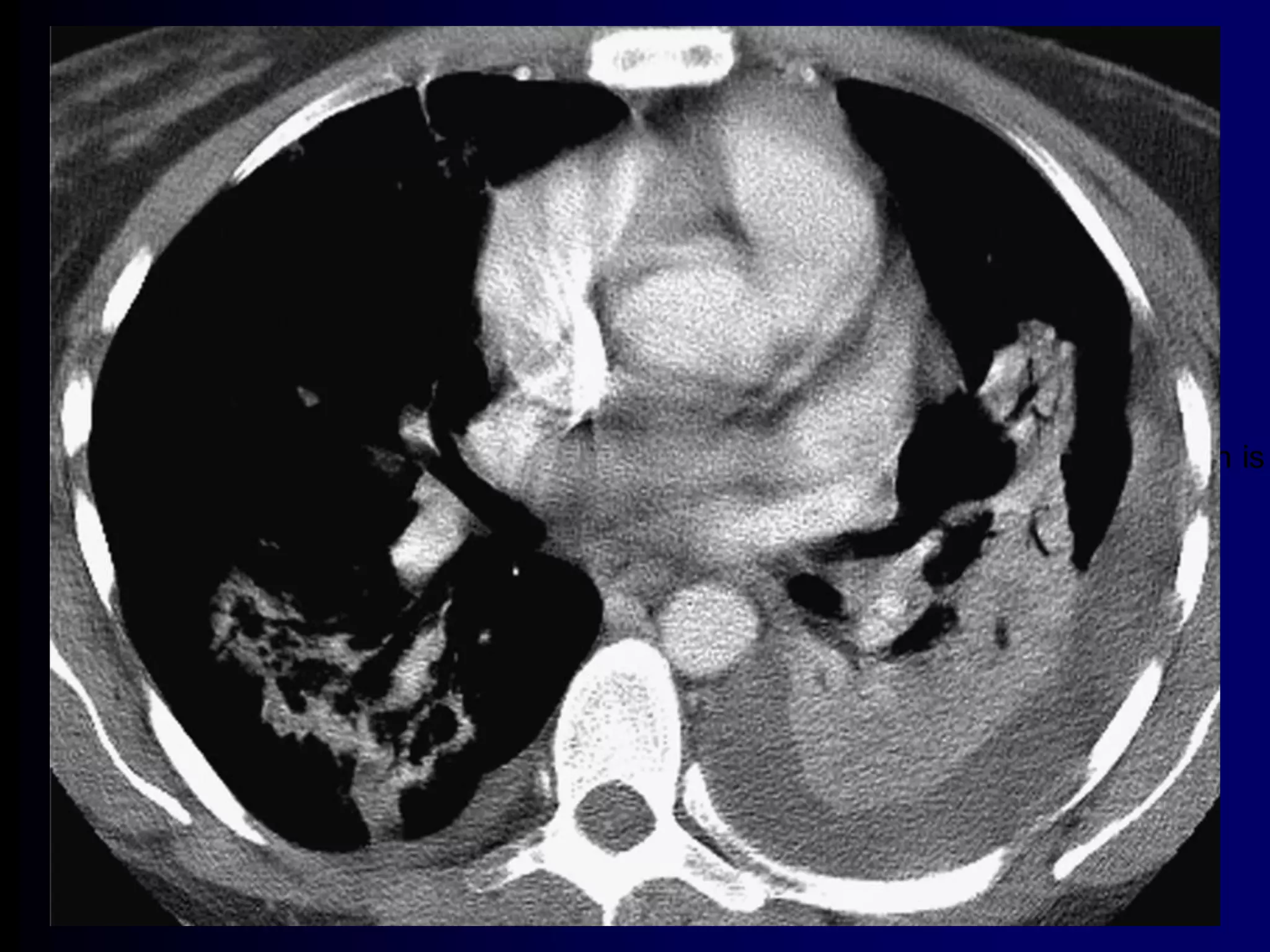 Updates in Parapneumonic Effusion and Empyema | PDF