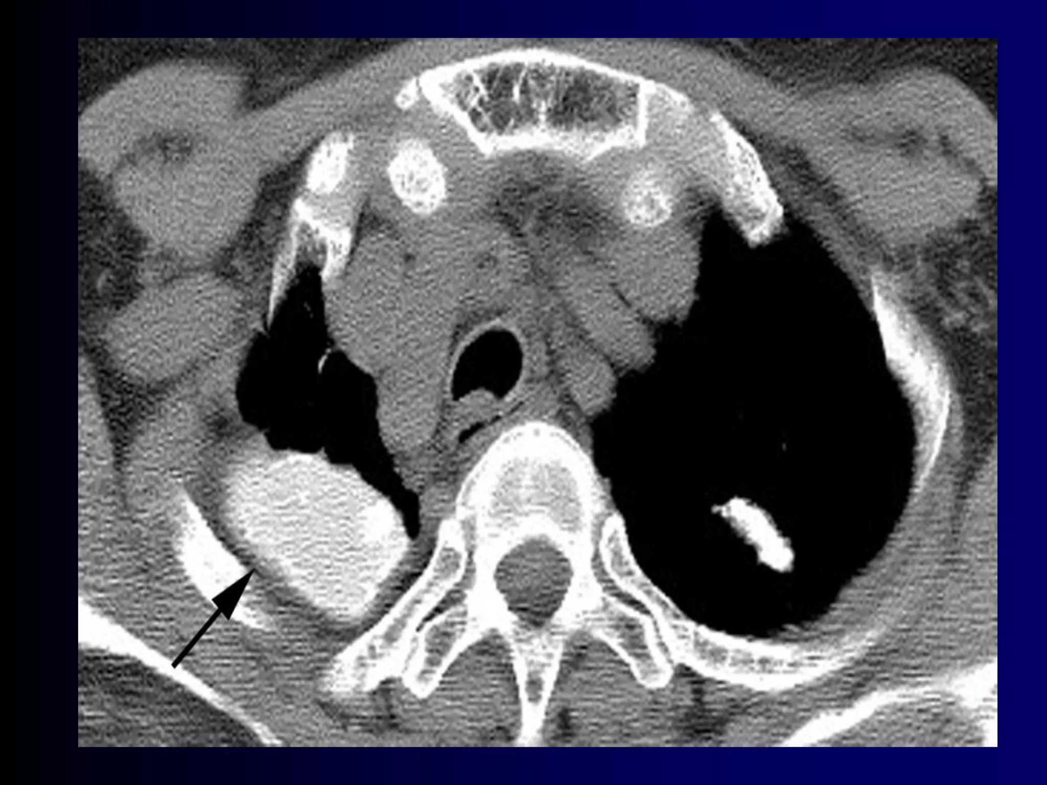 Updates in Parapneumonic Effusion and Empyema | PDF