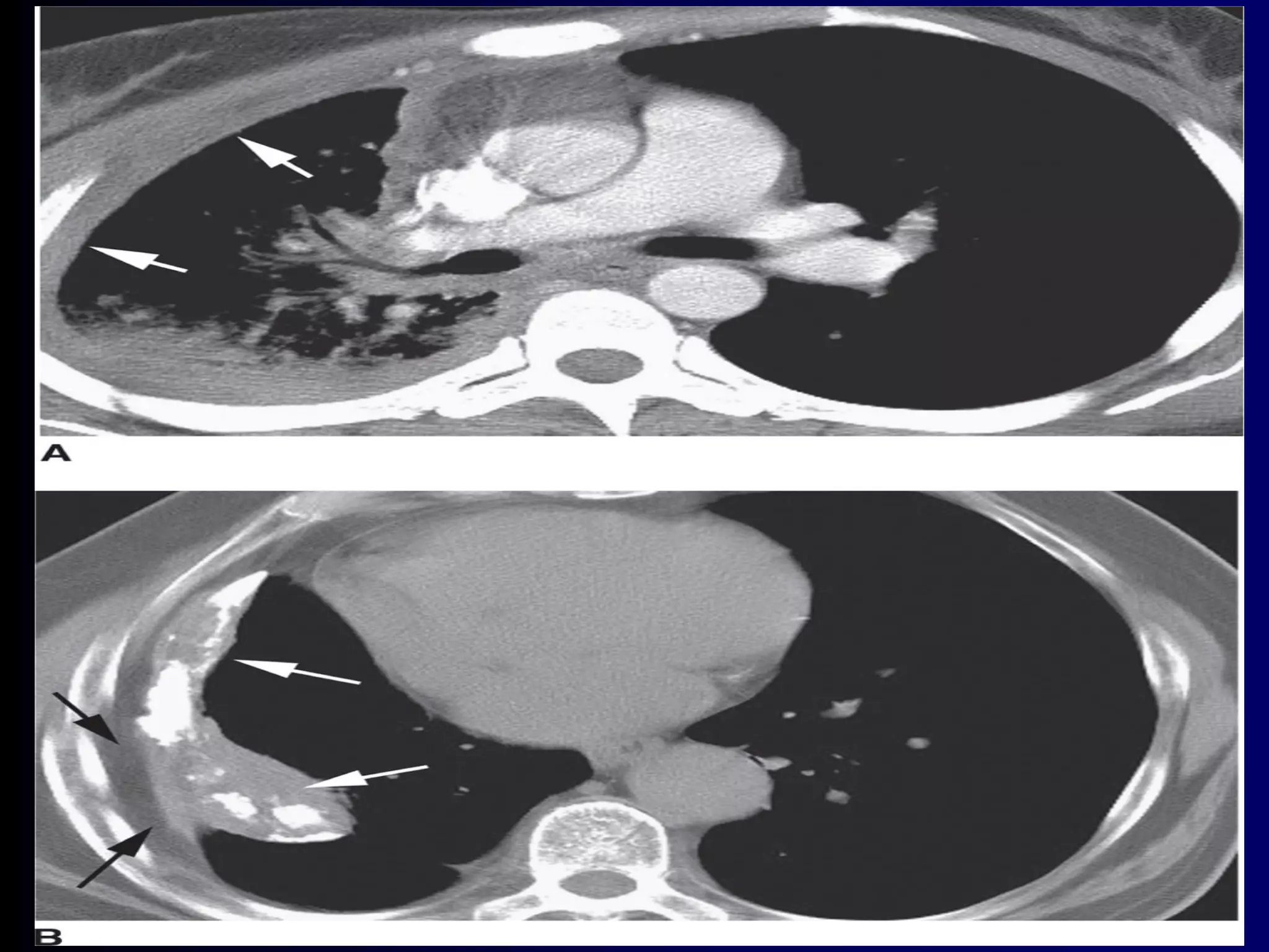 Updates in Parapneumonic Effusion and Empyema | PDF