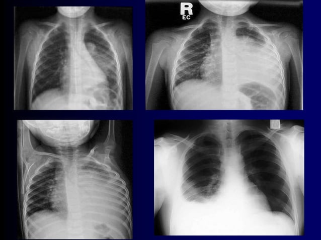 Updates in Parapneumonic Effusion and Empyema | PDF