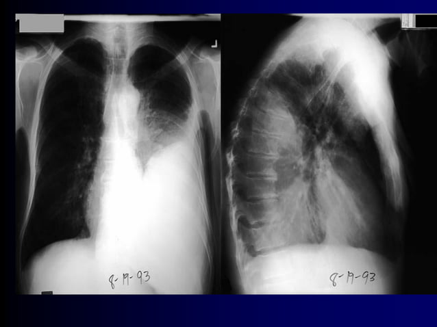 Updates in Parapneumonic Effusion and Empyema | PDF