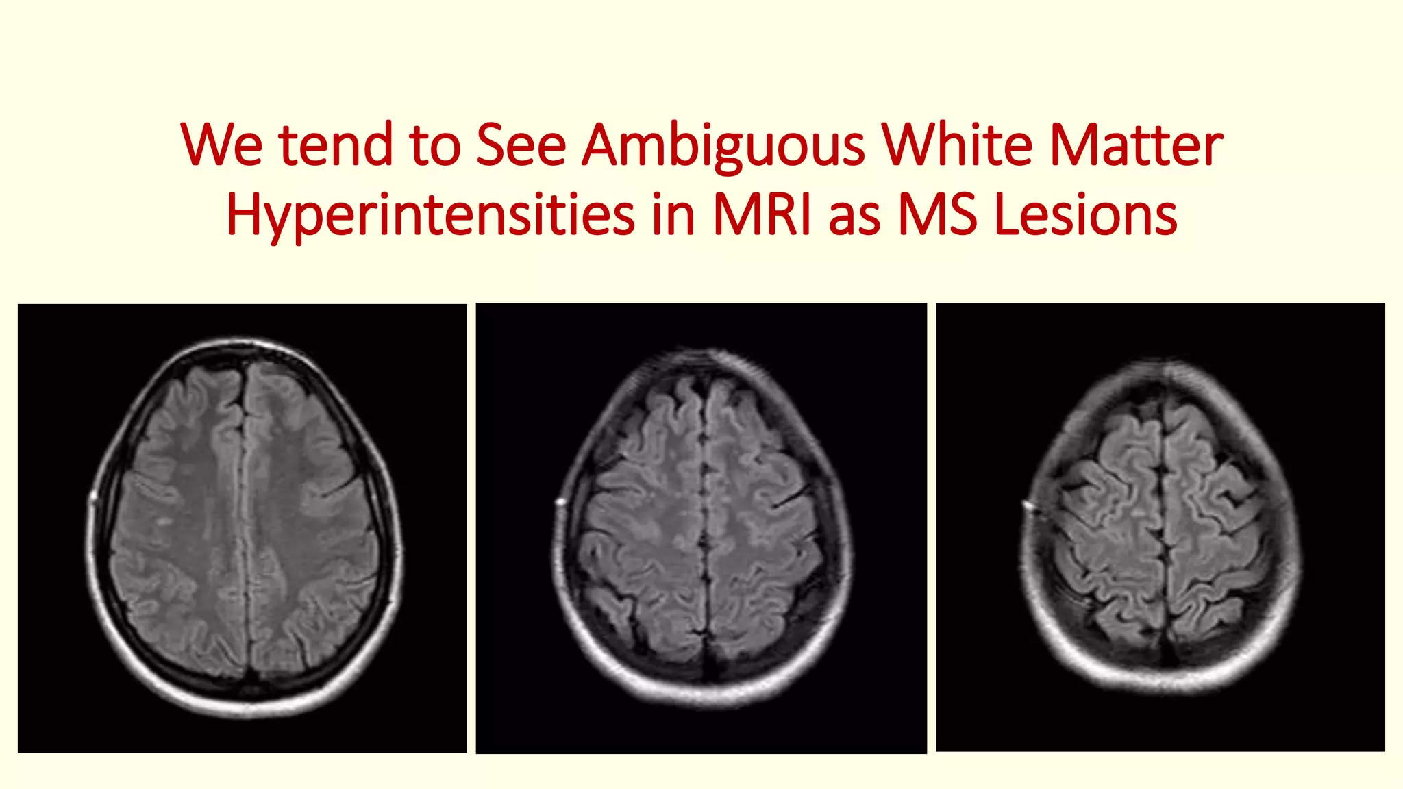 Updates of mri criteria for diagnosis of ms | PPTX