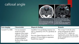 Idiopathic normal pressure hydrocephalus | PPT