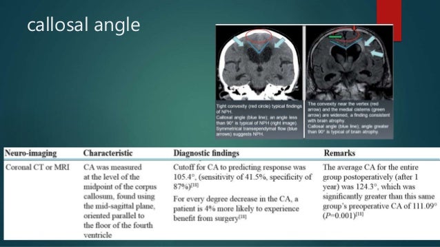 Idiopathic normal pressure hydrocephalus