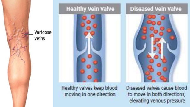 Update venous reflux | PPT | Free Download