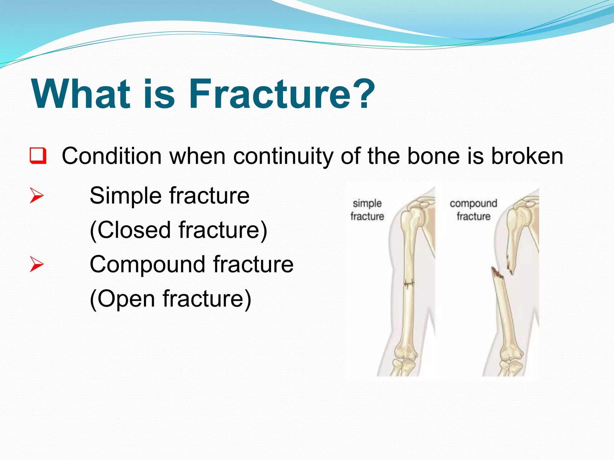First Aid Management of Fracture | PPTX