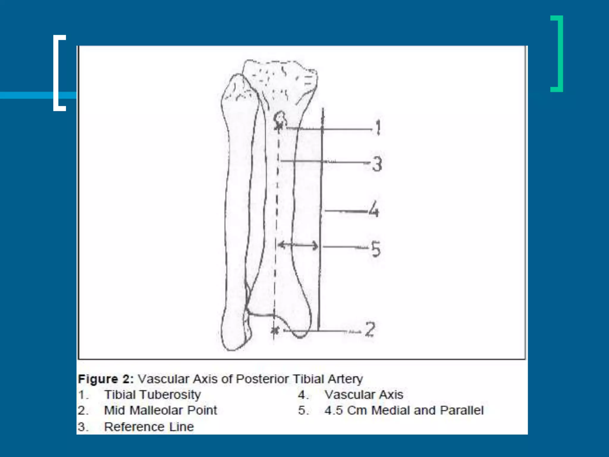 Uper n middle third leg defects | PPTX