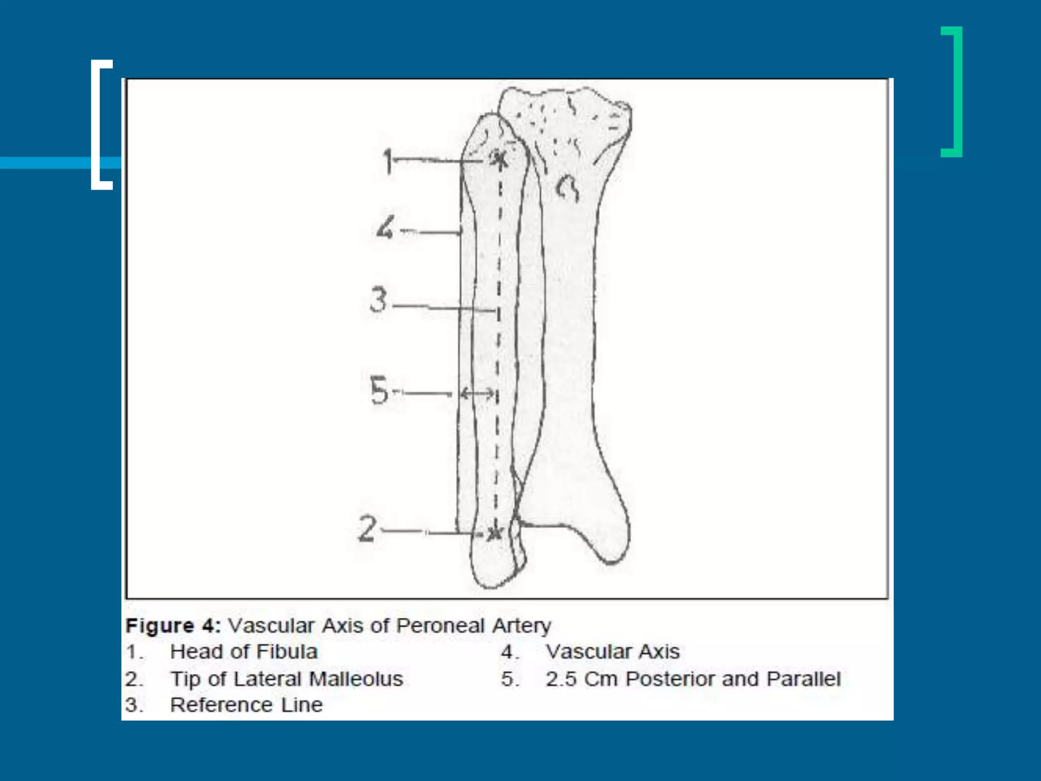 Uper n middle third leg defects | PPTX