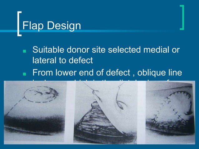 Uper n middle third leg defects | PPTX