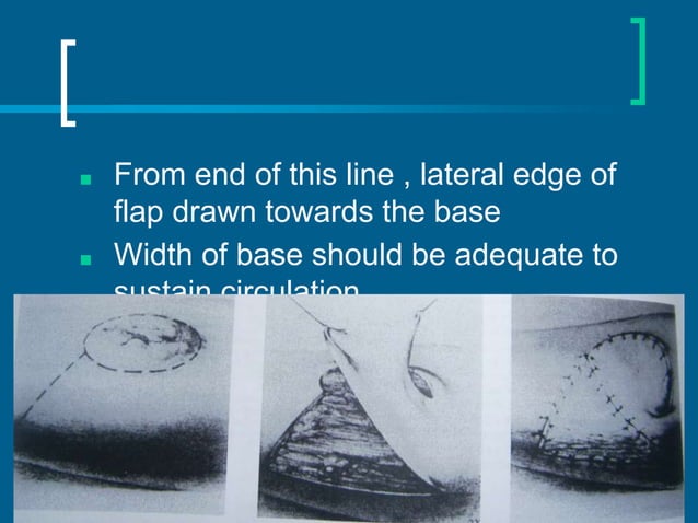Uper n middle third leg defects | PPTX