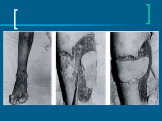Uper n middle third leg defects | PPTX