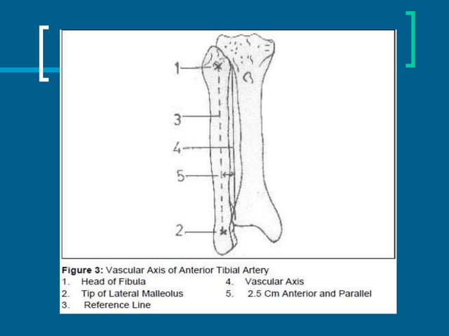 Uper n middle third leg defects | PPTX